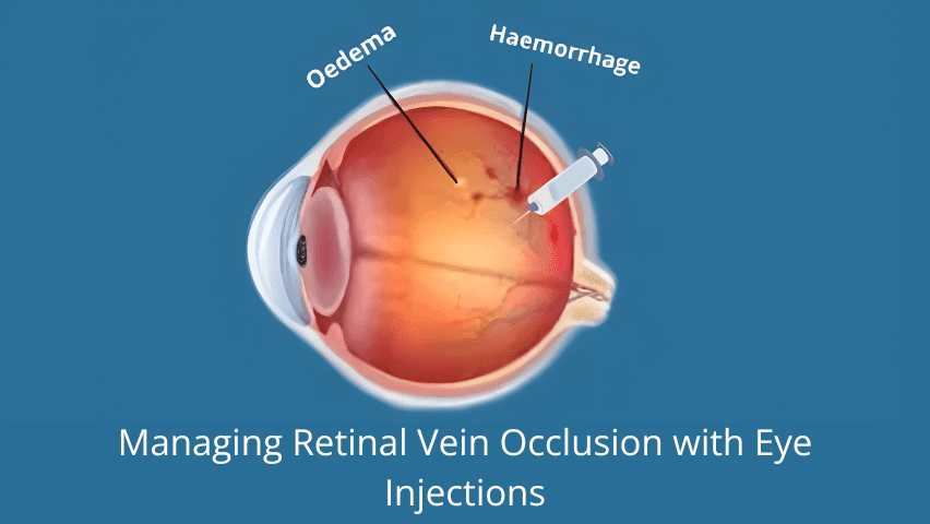 Treating Retinal Vein Occlusion Through Eye Injections