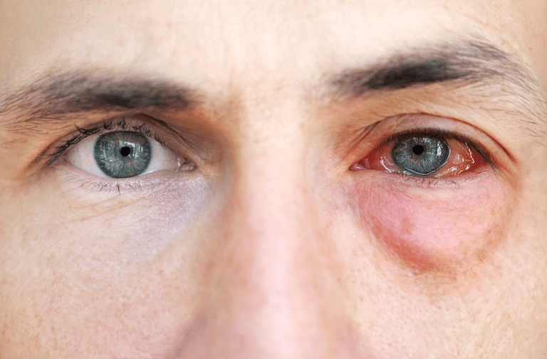 Red Eyes: Symptoms, Causes, Treatment & Prevention Tips