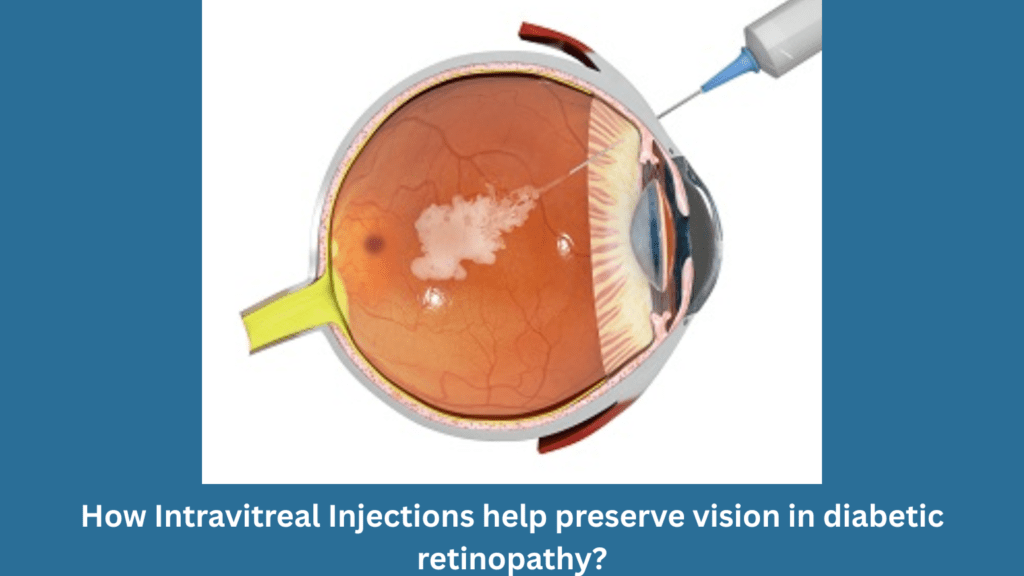 Treating Retinal Vein Occlusion Through Eye Injections