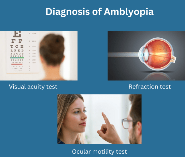 Amblyopia (Lazy Eye) - Causes, Symptoms and Treatment