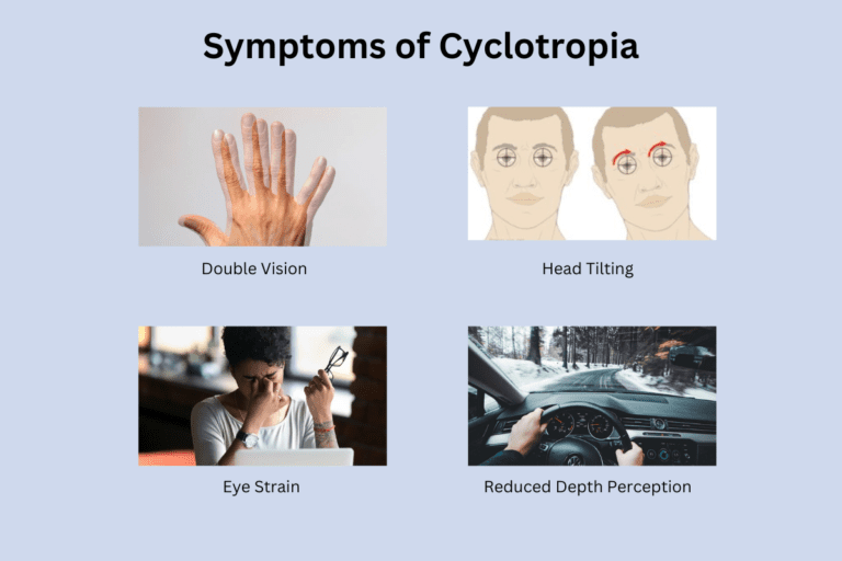 Cyclotropia: Causes, Symptoms, and Effective Treatments